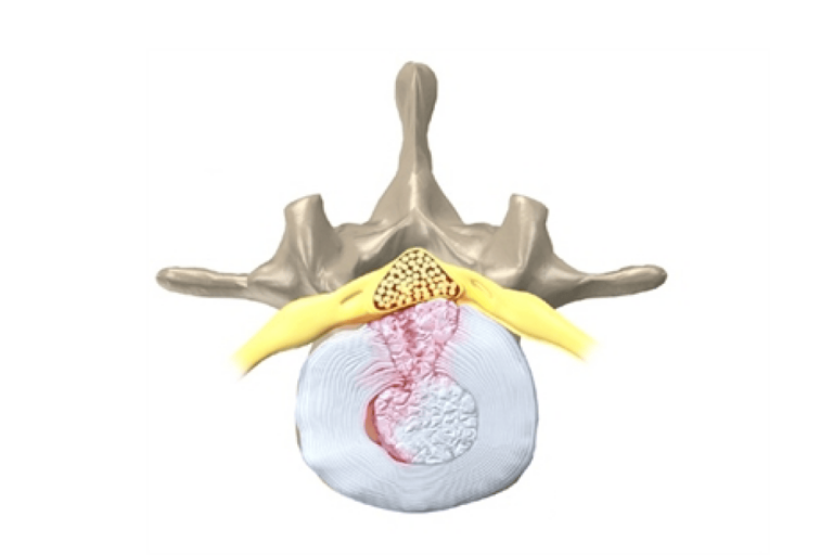 Cauda equina syndrome - Ishaan Ortho and Spine Clinic Bangalore