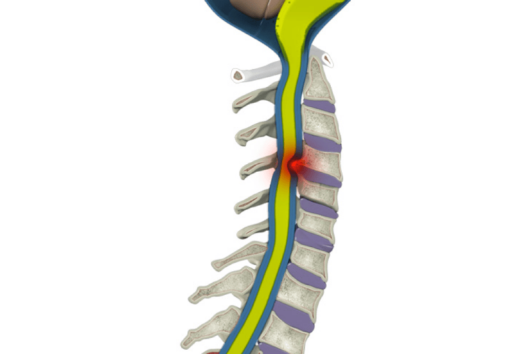 Cervical Spondylotic Myelopathy - Ishaan Ortho and Spine Clinic Bangalore