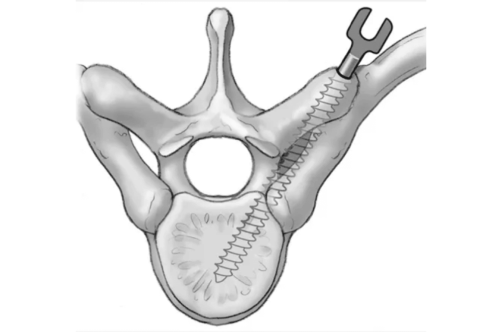 Posterior thoracic decompression using percutaneus techniques - Ishaan ...
