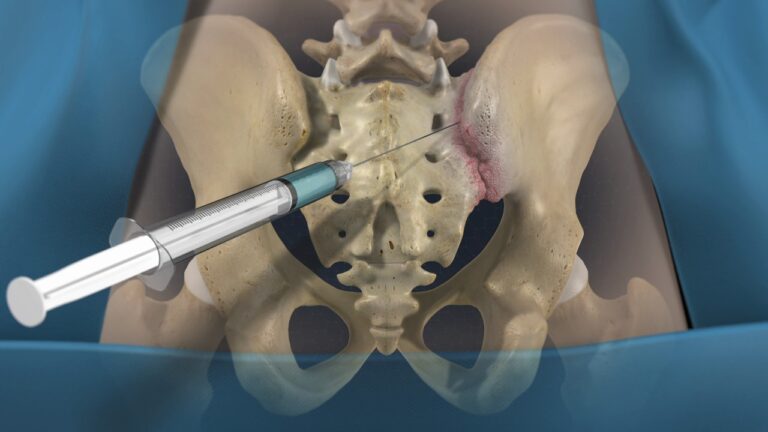 Sacroiliac Joint Block Treatment in Bangalore - Ishaan Ortho and Spine ...